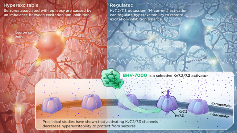 Focal Epilepsy | Potential New Treatment Option
